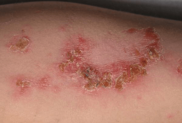 Skin Diseases and Disorders Jeopardy Template